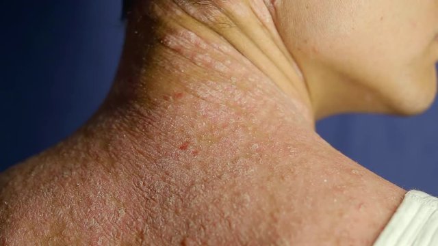 Neurodermatitis Images – Browse 459 Stock Photos, Vectors, and Video ...