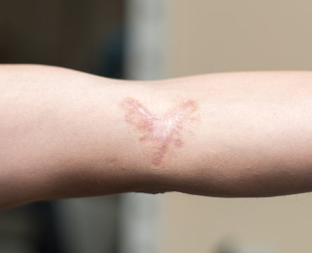 รูปภาพScar – เลือกดูภาพถ่ายสต็อก เวกเตอร์ และวิดีโอ1,831,033 | Adobe Stock