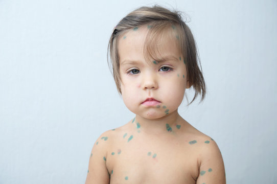 Waterpox Képek – Böngésszen 102 stockfotókat, vektorokat és videókat ...