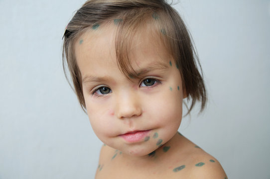 Imagens de Waterpox – Explore Fotografias do Stock, Vetores e Vídeos de ...