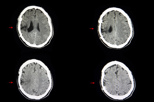 「Cerebromalacia」の写真素材 | 2件の無料イラスト画像 | Adobe Stock