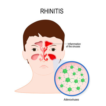 รูปภาพRhinitis – เลือกดูภาพถ่ายสต็อก เวกเตอร์ และวิดีโอ31,030 | Adobe Stock