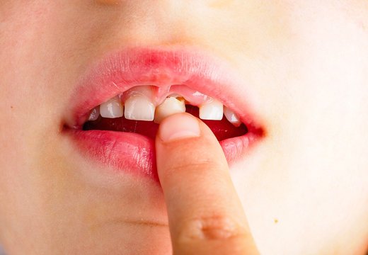 รูปภาพ"Loose Tooth" – เลือกดูภาพถ่ายสต็อก เวกเตอร์ และวิดีโอ325 | Adobe ...