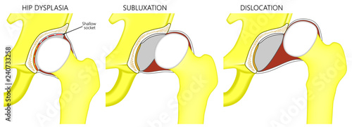 "Vector illustration anatomy of a hip joint with dysplasia, subluxation ...