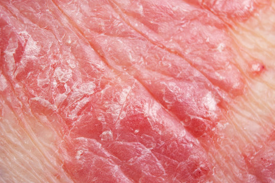 Erythroderma Images – Browse 62 Stock Photos, Vectors, and Video ...