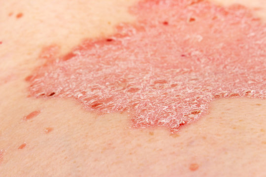 Erythroderma Images – Browse 53 Stock Photos, Vectors, and Video ...