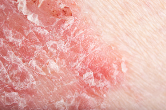 Erythroderma Images – Browse 63 Stock Photos, Vectors, and Video ...