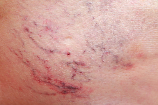 Lipodermatosclerosis Immagini - Sfoglia 150 foto, vettoriali e video ...