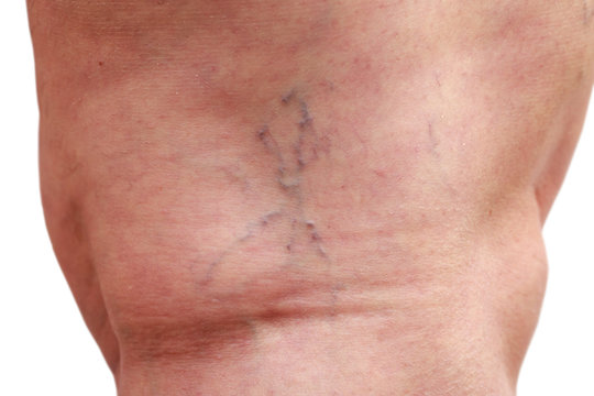 Lipodermatosclerosis Bilder – Durchsuchen 102 Archivfotos ...