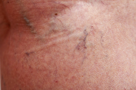 Lipodermatosclerosis bilder – Bläddra bland 85 stockfoton, vektorer och ...