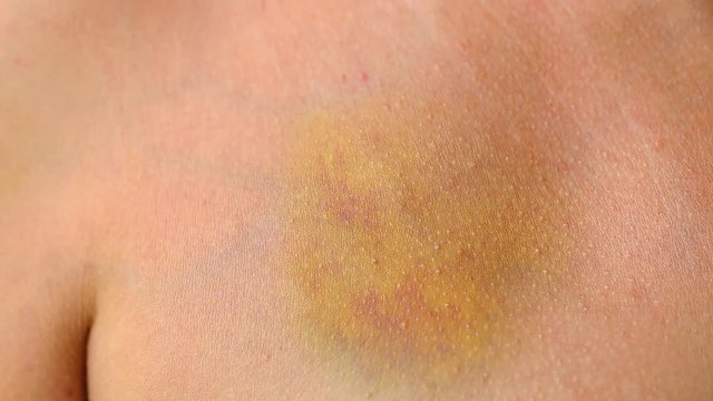 Blue(Bruise) Images – Browse 6,329 Stock Photos, Vectors, and Video ...
