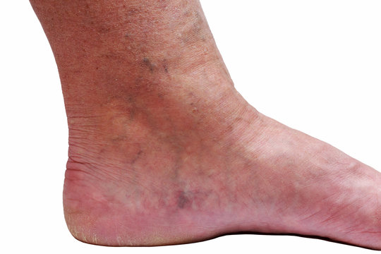 Lipodermatosclerosis Immagini - Sfoglia 113 foto, vettoriali e video ...