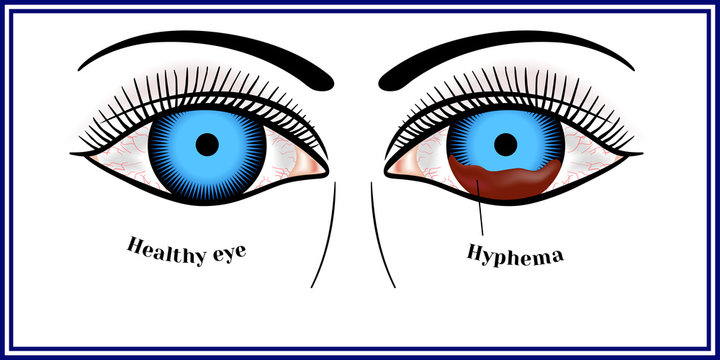 Hyphema Images – Browse 46 Stock Photos, Vectors, and Video | Adobe Stock