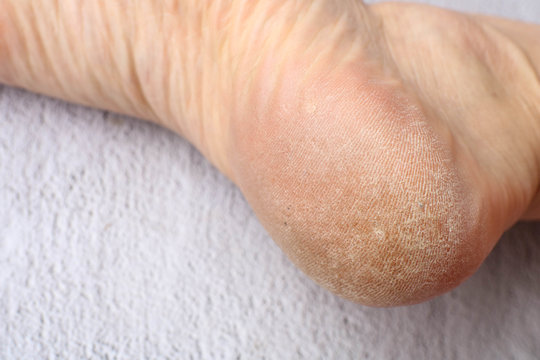 Callosity bilder – Bläddra bland 30,700 stockfoton, vektorer och videor ...