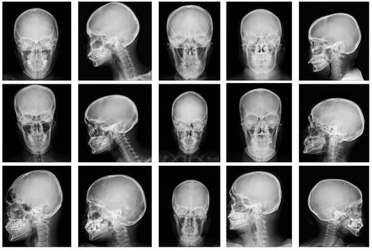 Scary X Ray Images – Browse 6,413 Stock Photos, Vectors, and Video ...