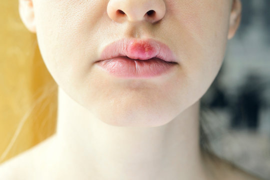 "Blisters Crust" Images – Browse 108 Stock Photos, Vectors, and Video ...
