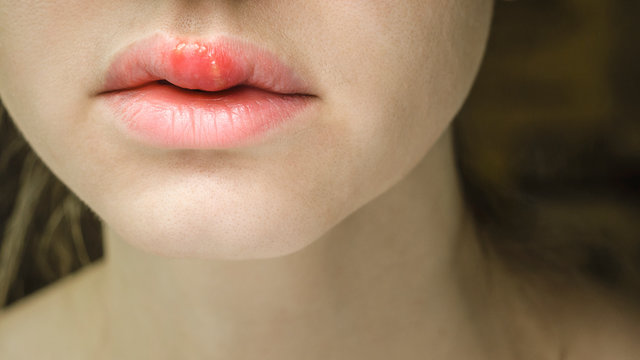 "Blisters Crust" Images – Browse 108 Stock Photos, Vectors, and Video ...