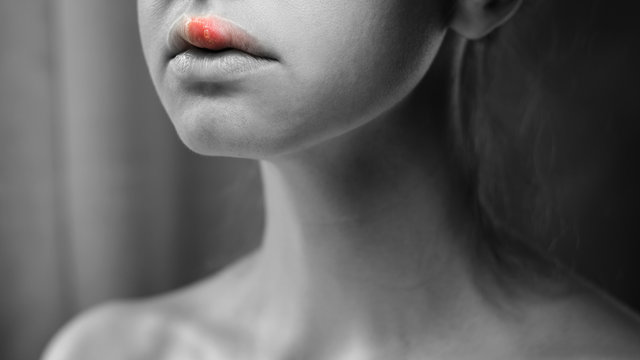 "Blisters Crust" Images – Browse 108 Stock Photos, Vectors, and Video ...