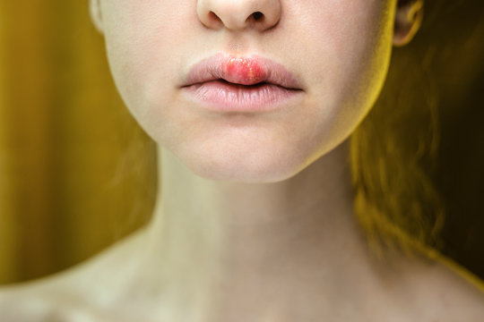 "Blisters Crust" Images – Browse 108 Stock Photos, Vectors, and Video ...