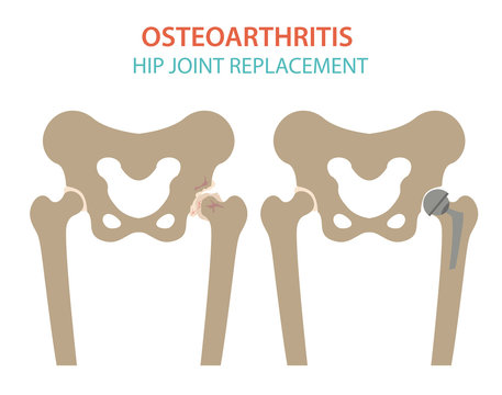 435,560 BEST Hip IMAGES, STOCK PHOTOS & VECTORS | Adobe Stock