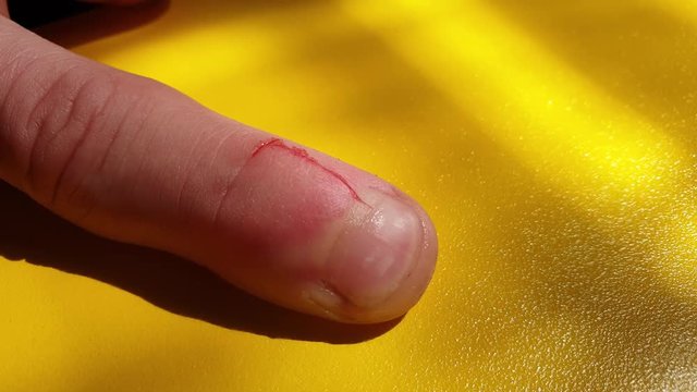 Finger Cut Images – Browse 683,249 Stock Photos, Vectors, and Video ...