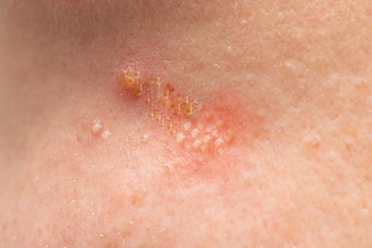 Pustules Images – Browse 509,991 Stock Photos, Vectors, and Video ...