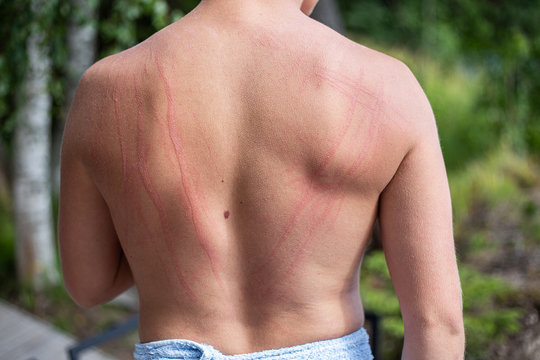 Dermatographism Images – Browse 204 Stock Photos, Vectors, and Video ...