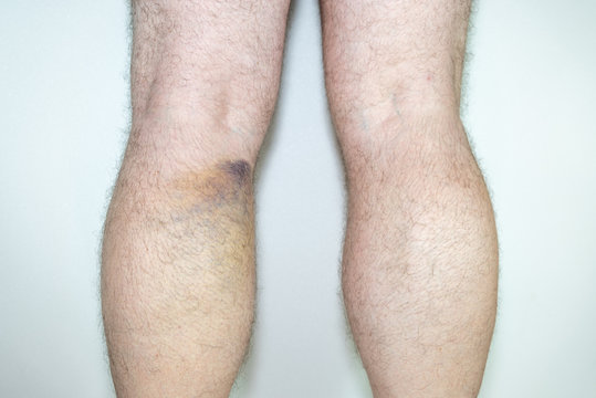 Muskelfaserriss Bilder – Durchsuchen 88 Archivfotos, Vektorgrafiken und ...