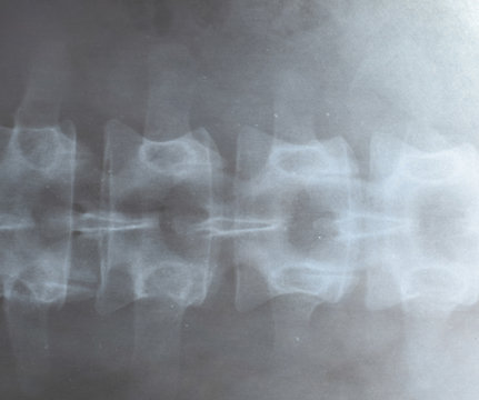 Spondylarthrose Bilder – Durchsuchen 276 Archivfotos, Vektorgrafiken ...