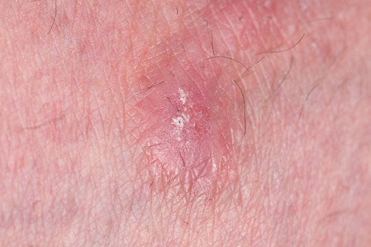 928 BESTE Wundrose BILDER, STOCK-FOTOS & -VEKTORGRAFIKEN | Adobe Stock