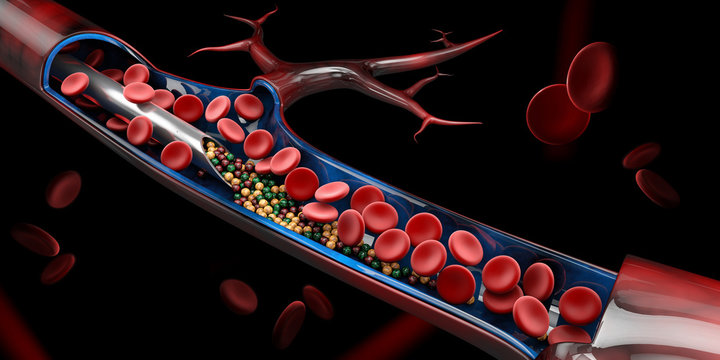 Thrombosespritze-Bilder: Stock-Fotos & -Videos. | Adobe Stock