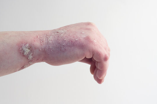 รูปภาพDermatose – เลือกดูภาพถ่ายสต็อก เวกเตอร์ และวิดีโอ132 | Adobe Stock