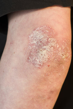 รูปภาพDermatose – เลือกดูภาพถ่ายสต็อก เวกเตอร์ และวิดีโอ132 | Adobe Stock