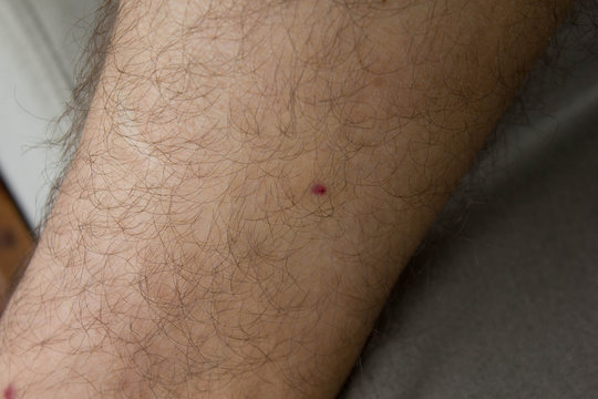 Leech Bite Scar