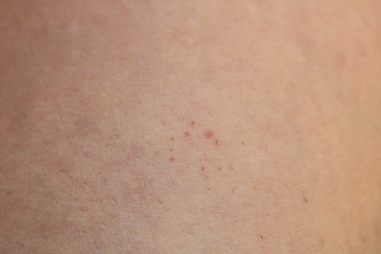 Schamberg bilder – Bläddra bland 19 stockfoton, vektorer och videor ...