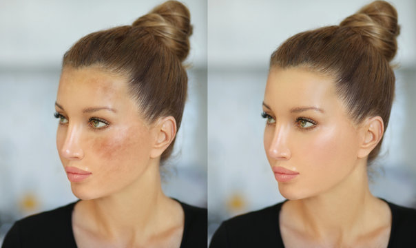 「Chloasma」の画像 - 2,340 件の Stock 写真、ベクターおよびビデオ | Adobe Stock