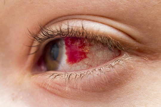 Bindehautsack Bilder – Durchsuchen 1,684 Archivfotos, Vektorgrafiken ...