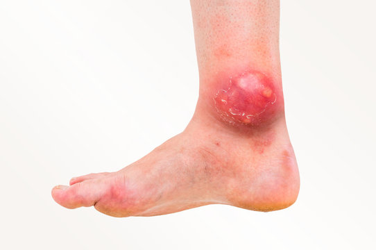 「Furunculus」の画像 - 16 件の Stock 写真、ベクターおよびビデオ | Adobe Stock