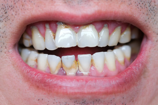 Dental Calculus Images – Browse 134,789 Stock Photos, Vectors, and ...