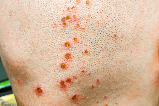Hydriodic Acid Burn