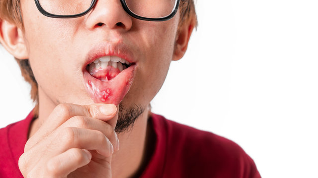 รูปภาพAphthous – เลือกดูภาพถ่ายสต็อก เวกเตอร์ และวิดีโอ451 | Adobe Stock