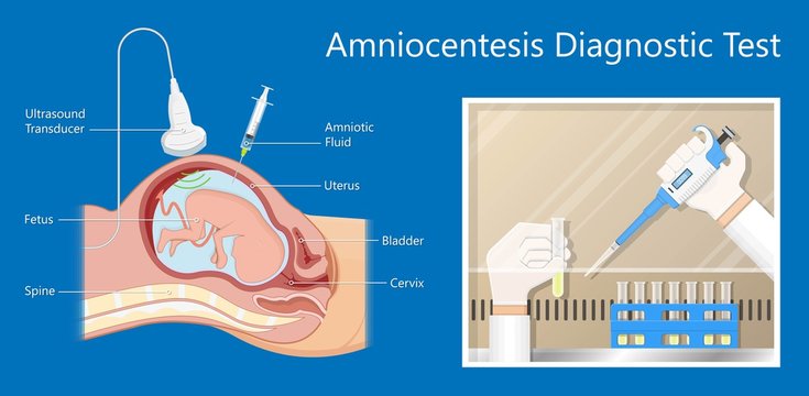 Imágenes de Amniocentesis: descubre bancos de fotos, ilustraciones ...