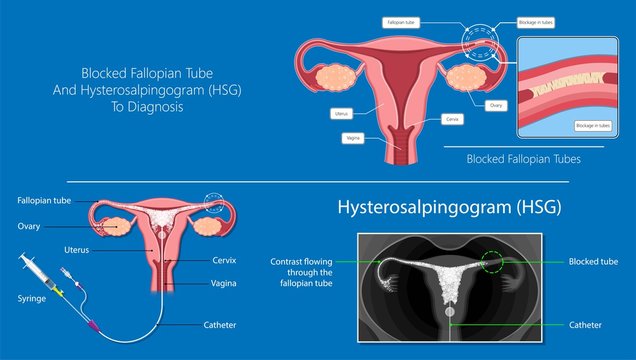 16 BEST Hysterosalpingogram IMAGES, STOCK PHOTOS & VECTORS | Adobe Stock