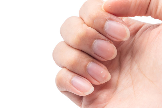 รูปภาพFingernails – เลือกดูภาพถ่ายสต็อก เวกเตอร์ และวิดีโอ946,067 ...