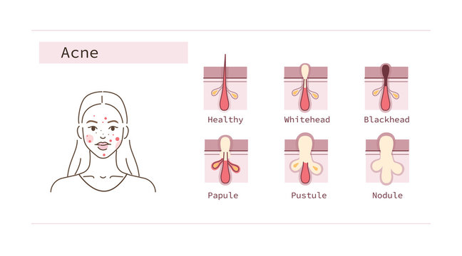 Comedones Images – Browse 424 Stock Photos, Vectors, and Video | Adobe ...