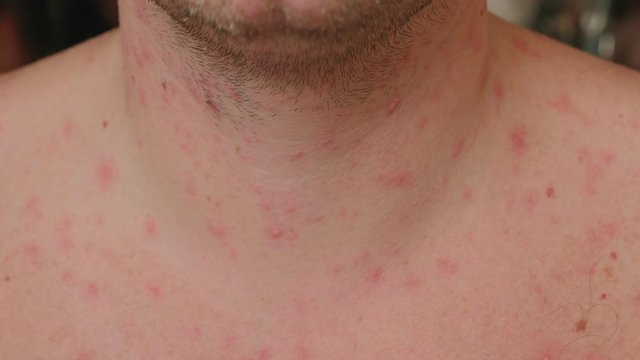 Skin Shingles Images – Browse 18,794 Stock Photos, Vectors, and Video ...