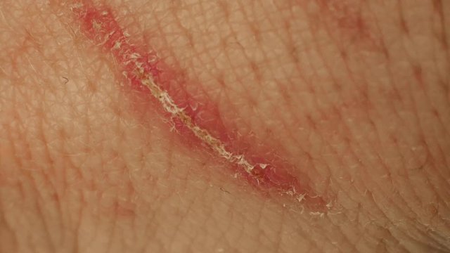 รูปภาพScab – เลือกดูภาพถ่ายสต็อก เวกเตอร์ และวิดีโอ21,973 | Adobe Stock