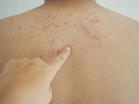 "Prickly Heat" Images – Browse 1,372 Stock Photos, Vectors, and Video ...