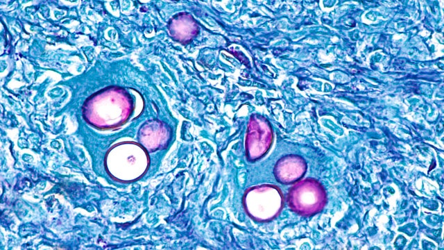 Coccidioidomycosis Spherules