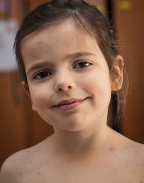 Imagens de Waterpox – Explore Fotografias do Stock, Vetores e Vídeos de ...